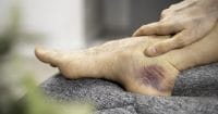 Common Dance Injuries and How To Prevent Them | Stagestep
